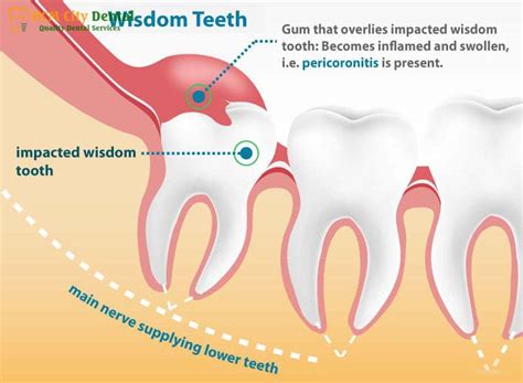 Wisdom Teeth Function Whats Their True Purpose Explained Dr