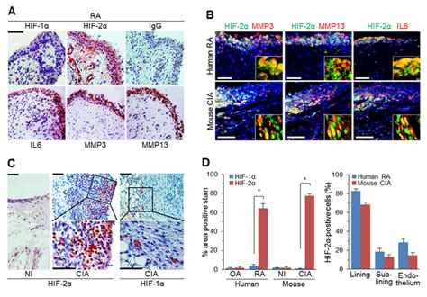 Hif 1α And Hif 2α Are Differentially Up Regulated In Ra Synovium A