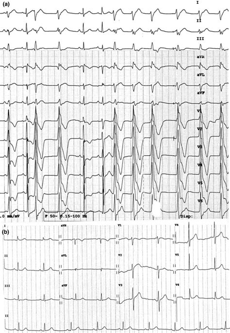 Panel A Electrocardiogram Taken 2 Days After The Ablation Procedure Download Scientific