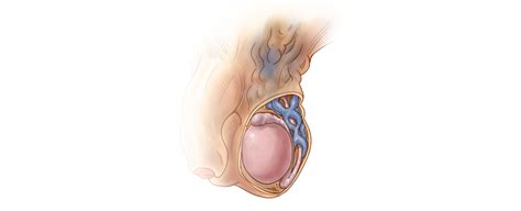 Can Varicocele Cause Erectile Dysfunction Understanding The Link Medagg