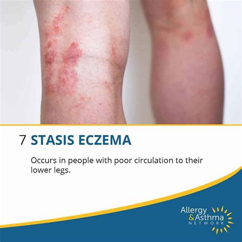 What Is Eczema Allergy And Asthma Network