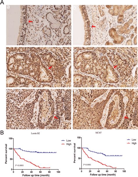 Lamin B2 And Mcm7 Expression In Clinical Nsclc Samples A