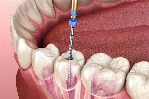 Root Canal Cost Sydney Cbd Dentistry