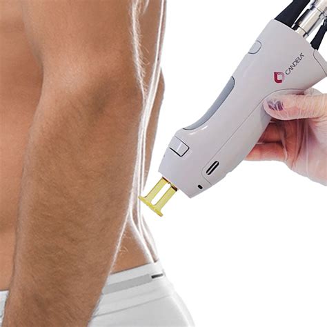 Лазерна епилация мъже на кръст цена