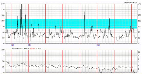 Fetal Tracing Index Electronic Fetal Monitoring