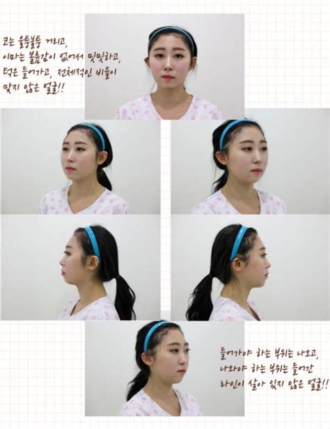 메디콕 얼굴지방이식 수미의 얼굴 볼륨감 되찾기 프로젝트 1 부위 얼굴 2 수술시술명