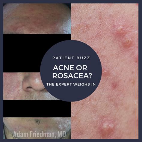 Patient Buzz Acne Or Papulopustular Rosacea The Expert Weighs In