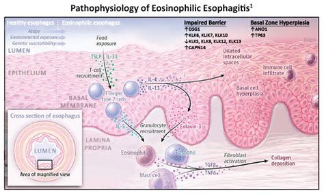 Eoe Pathophysiology Eoe Restore Clinician