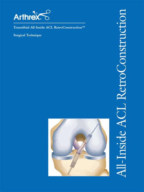 Transtibial All Inside Acl Retroconstruction Pdf