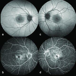 Fundus Autofluorescence Showing Paracentral Hyperautofluorescence In
