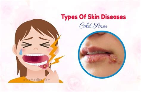 Top 7 Common Types Of Skin Diseases Causes Symptoms Diagnosis