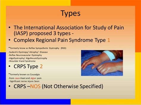 Crps Type 2