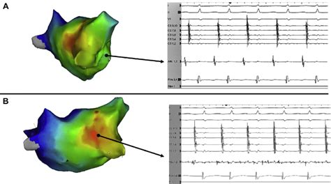 Electroanatomic Mapping Of The Left Atrium La A Right Posterior Download Scientific Diagram