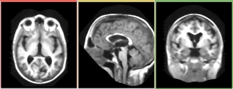 Modulesmedianfilter Documentation 36 Slicer Wiki