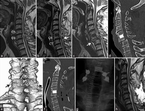 Cervical Facet Dislocation Adjacent To The Fused Motion Segment Journal Of Neurosciences In