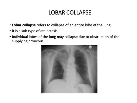 Lobar Collapse Xray Pptx