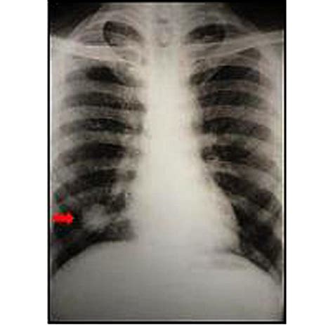 Chest X Ray Nodular Opacity Apical Region Of Right Lung Download