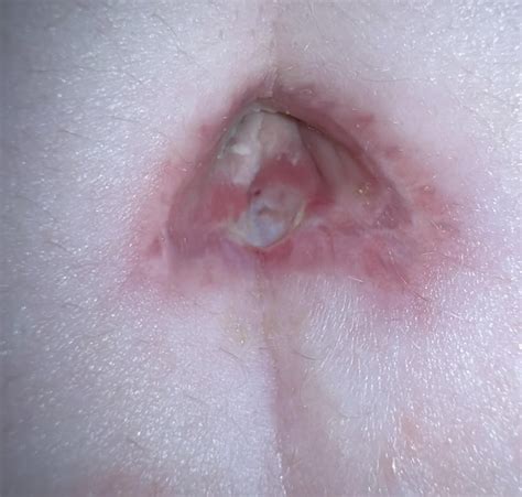 Belly Button After Abdominoplasty Spoilered Images Rwoundcare