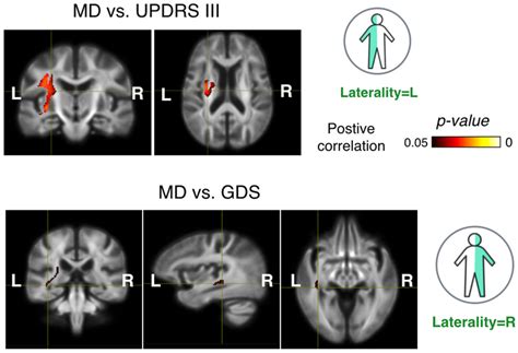 correlation between dti metrics fa and md and clinical evaluations in