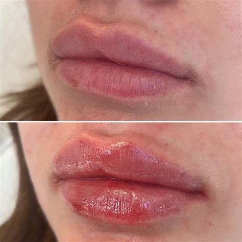 Https Instagram Com P Clzjml Dfj Igshid Nz R F R Botox Fillers Lip Fillers Lip