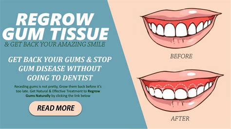 Regrow Gum Tissue Naturally By Dawngrove Issuu