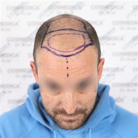 Fue Hair Transplant With Dr Acar Cosmedica Istanbul Turkey Hair