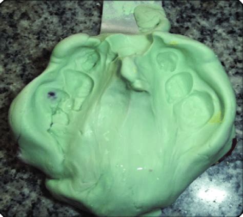 Primary Impression Made With Heavy Consistency Rubber Base Impression