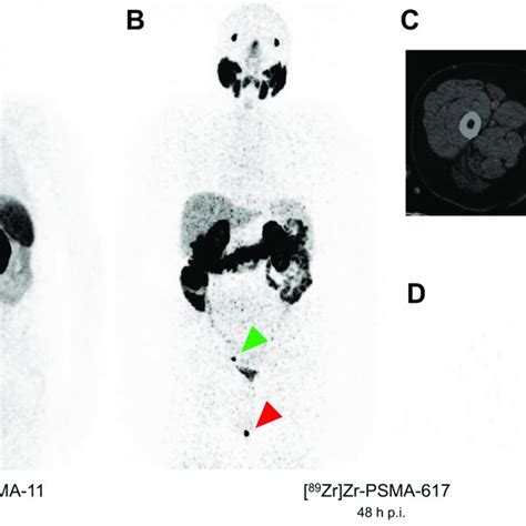 Molecular Imaging A Mip Maximum Intensity Projection Of [ 68