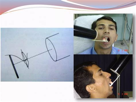 Parallel Angle Technique Vs Bisecting Angle Technique PPTX Dental Health Diseases And