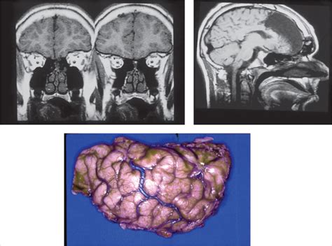 10 Frontal Lobe Resection In Refractory Epilepsy Neupsy Key