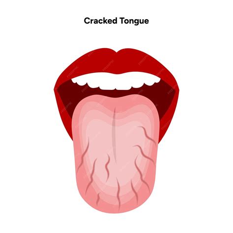 Premium Vector Cracked Tongue Problem In Human