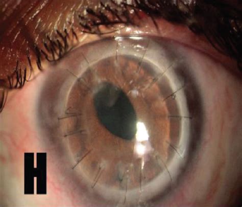 A Slit Lamp Photo Of Case 5 At 1st Visit Showing Ciliary Injection Download Scientific