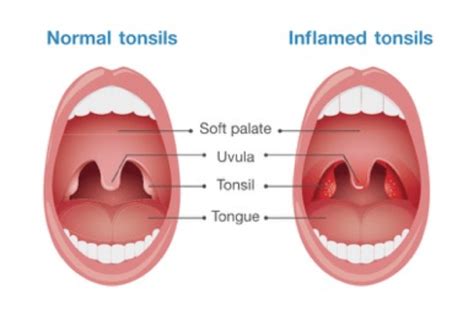 How To Get Rid Of Tonsil Stones Tonsil Stone Removal Vs Tonsillectomy