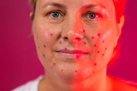 여드름 문제가 자극통증을 느끼는 것에 대해 걱정하는 여성의 사진을 클로즈업하고 그녀는 얼굴에서 여드름 반점을 제거하는 자외선 절차를 거칩니다 건강관리와 의술에 대한 스톡