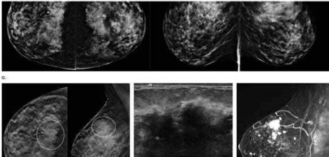 논문 리뷰 Computer Aided Detection And Classification Of Mammograms Using