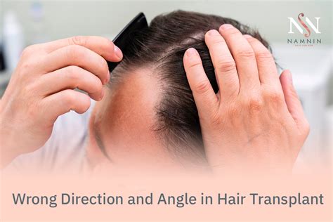 Wrong Direction And Angle” In Hair Transplant
