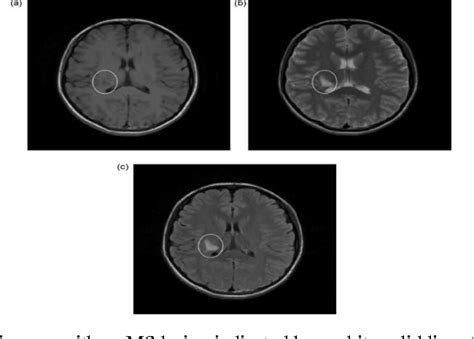 Figure 2 From Automatic Lesion Segmentation Ofmultiple Sclerosis In Mri Imagesusing Supervised
