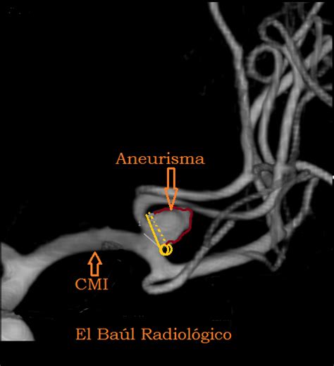 El Baúl Radiológico Artefactos En Irm Producidos Por Clips