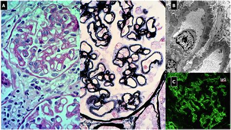 Diffuse Membranous Glomerulonephritis