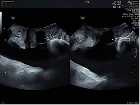Ics 2021 Abstract 121 Usability Of Transperineal Ultrasound For The Evaluation Of Pelvic Organ