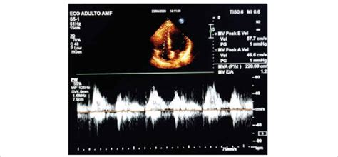 Pulsatile Spectral Doppler Ultrasound Image Of The Tricuspid Flow Used Download Scientific