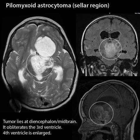 Clinical Pathology Glossary Pilomyxoid Astrocytoma Ditki Medical