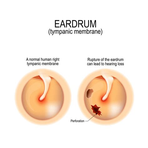 Perforated Ear Drum