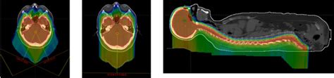 Proton Pencil Beam Scanning Craniospinal Irradiation Csi With A