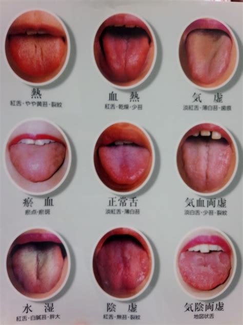 中医学的診断方法 舌診ぜつしん 巡心堂漢方薬局