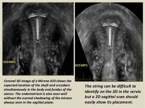 Mirena Ultrasound Appearance