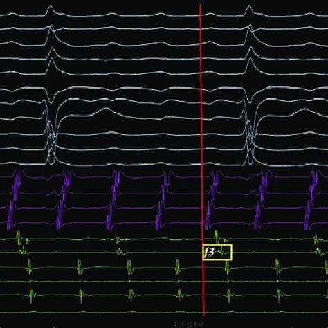 The Relationship Of F1 And F2 Fragmented Signals With P Wave Onset