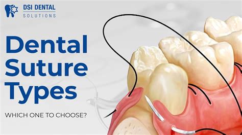 Types Of Sutures In Dentistry At Emilie Benson Blog