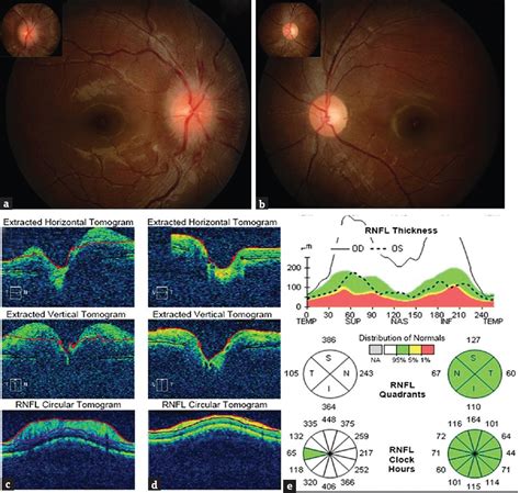 Unilateral Papilledema In Cerebral Venous Sinus Thrombosis Journal Of Neurosciences In Rural