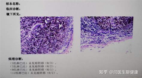 浸润性肺癌多数预后不好而这种浸润性肺癌预后极好生存率高 知乎